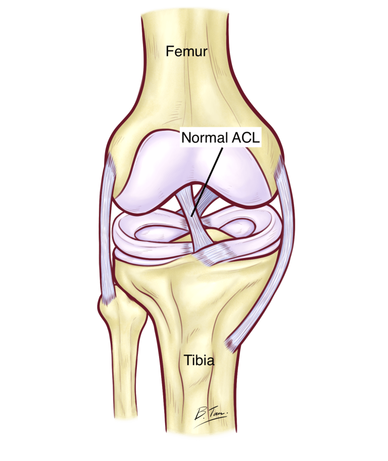 Anterior Cruciate Ligament ACL Surgery Singapore Dr Bryan Tan Anterior Cruciate Ligament ACL Surgery Singapore Dr Bryan Tan